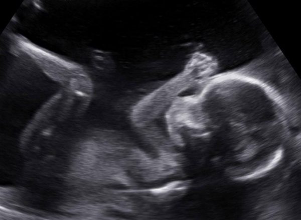 Pretecho, geslachtsbepaling, 3D/4D pretecho | KeK Echo Westland